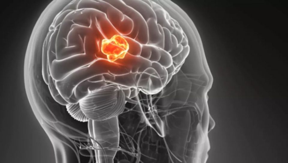 Síndrome de la silla turca vacía - Gamma Knife